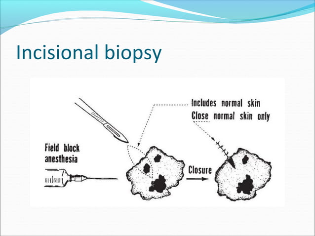 Biopsy | PPT | Dental Health | Diseases and Conditions