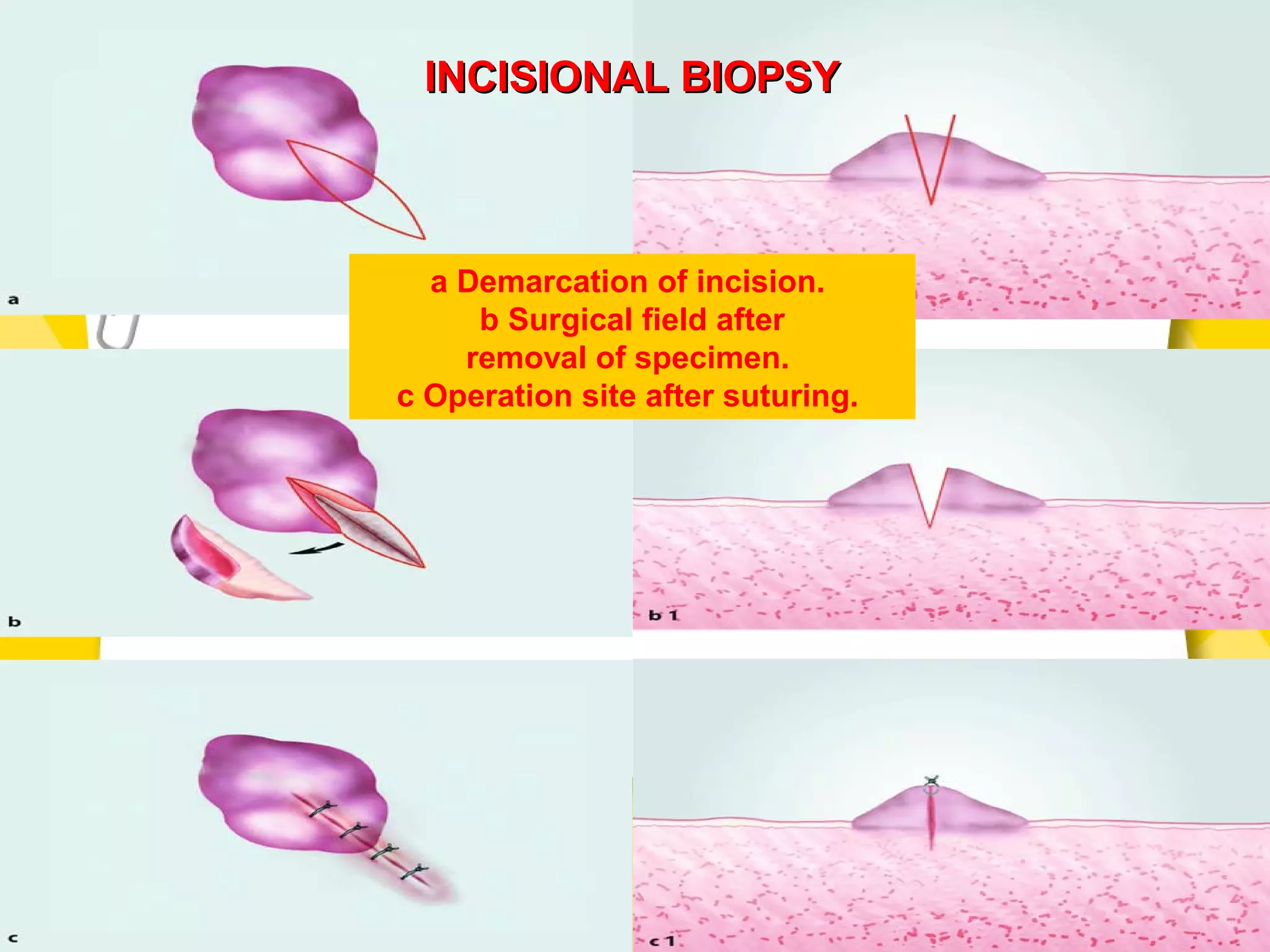 Biopsy | PPT