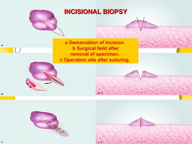 Biopsy | PPT