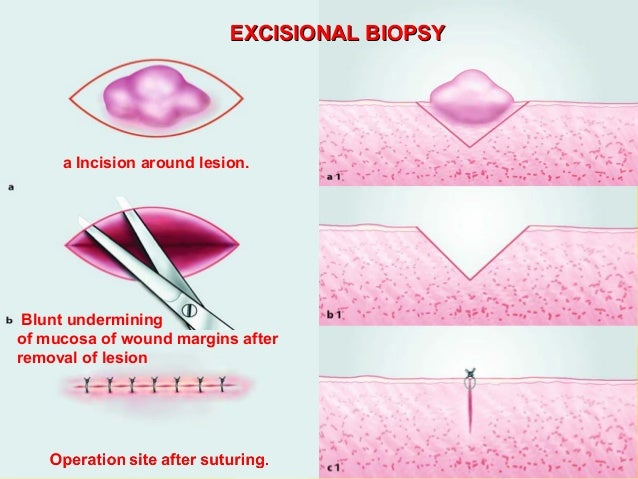 Biopsy