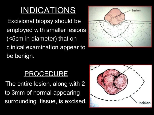 Biopsy