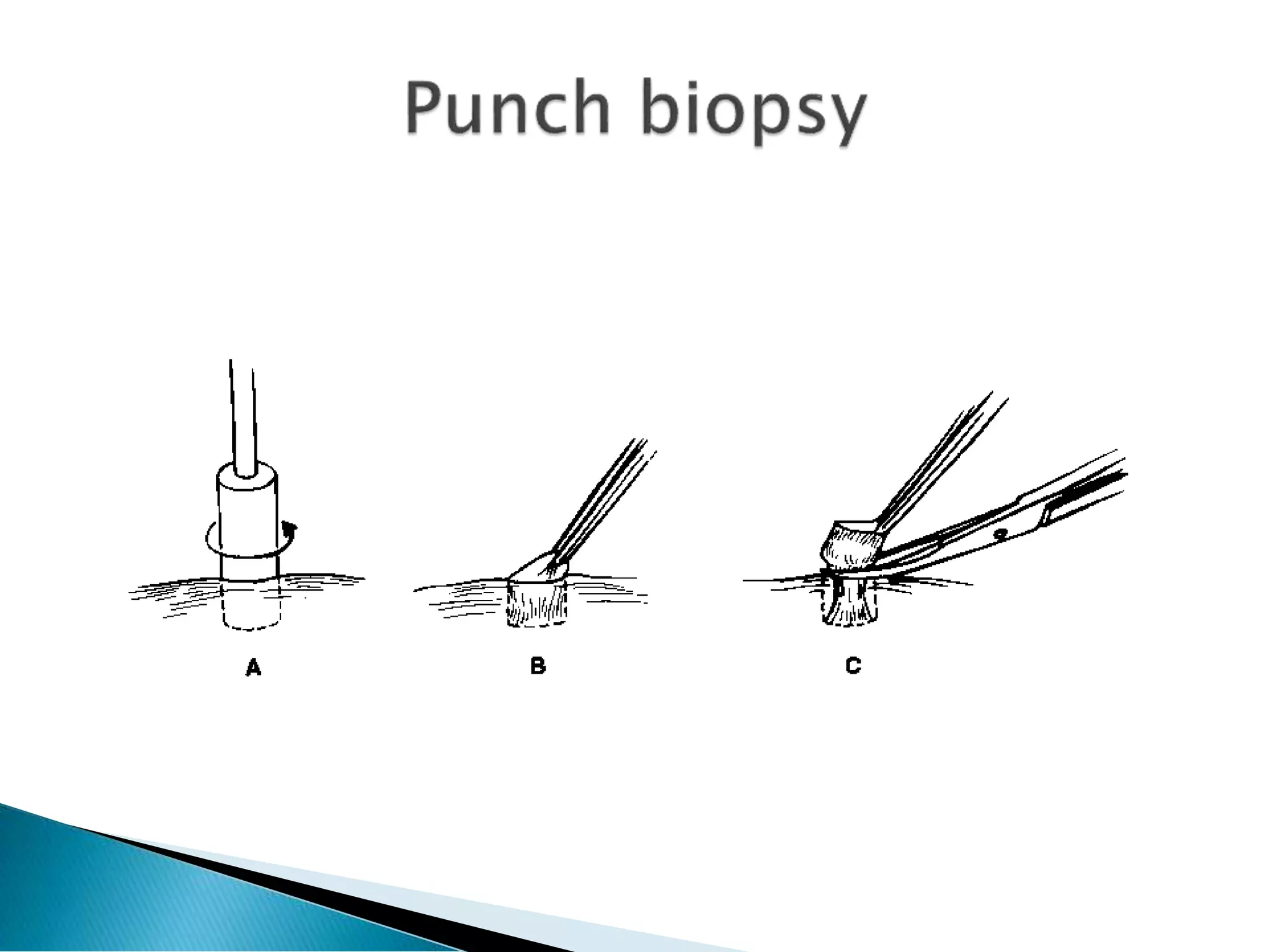 Biopsy | PDF