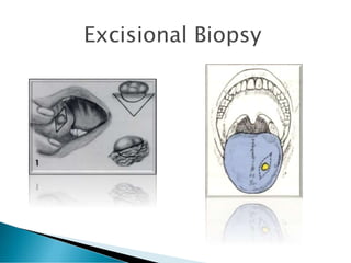Biopsy | PDF