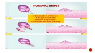 biopsy.pptx