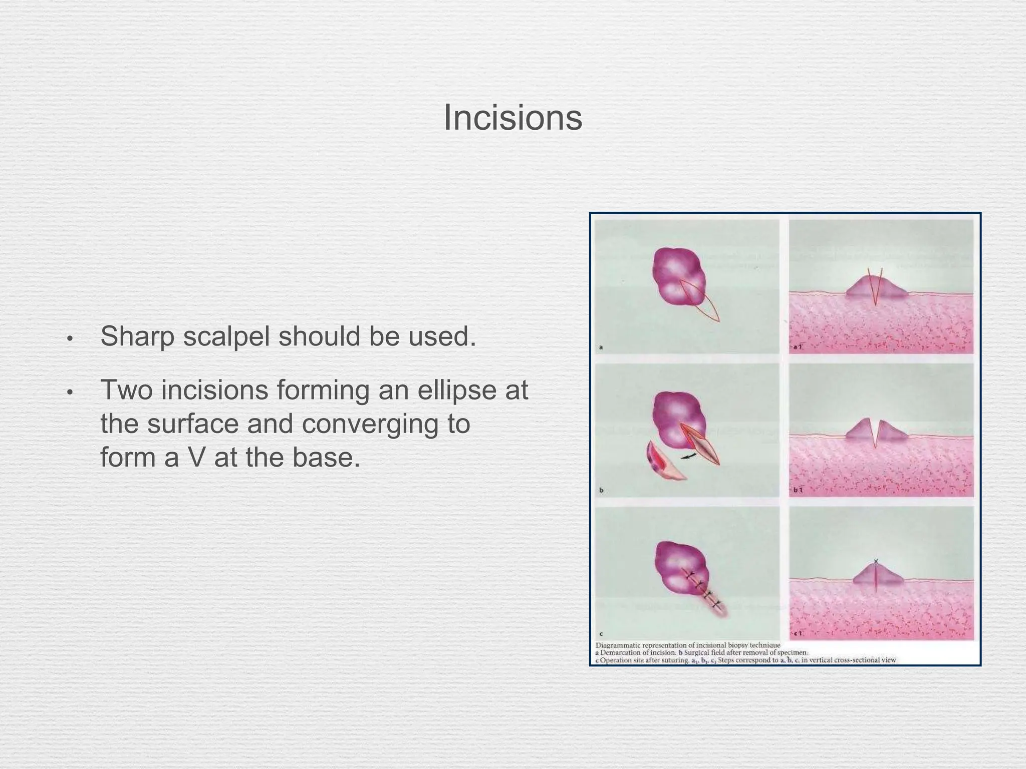 BIOPSY clinical procedure which aids in diagnosis and treatment ...
