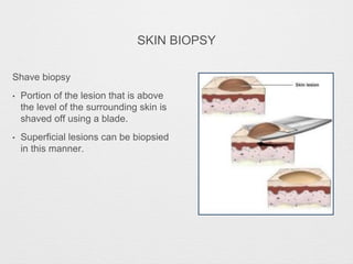 BIOPSY clinical procedure which aids in diagnosis and treatment ...