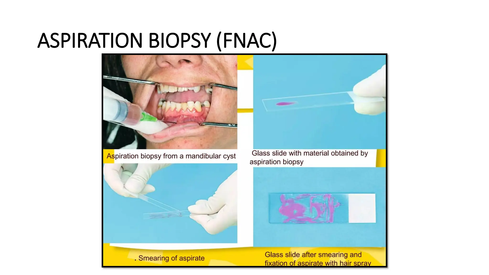 Biopsy of tissues and muscles Definition | PDF