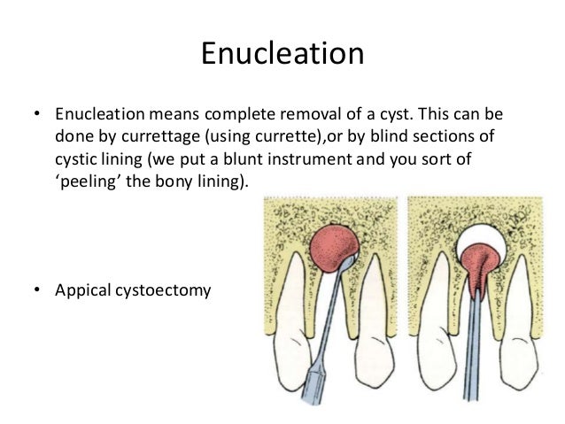 Biopsy and cyst managment
