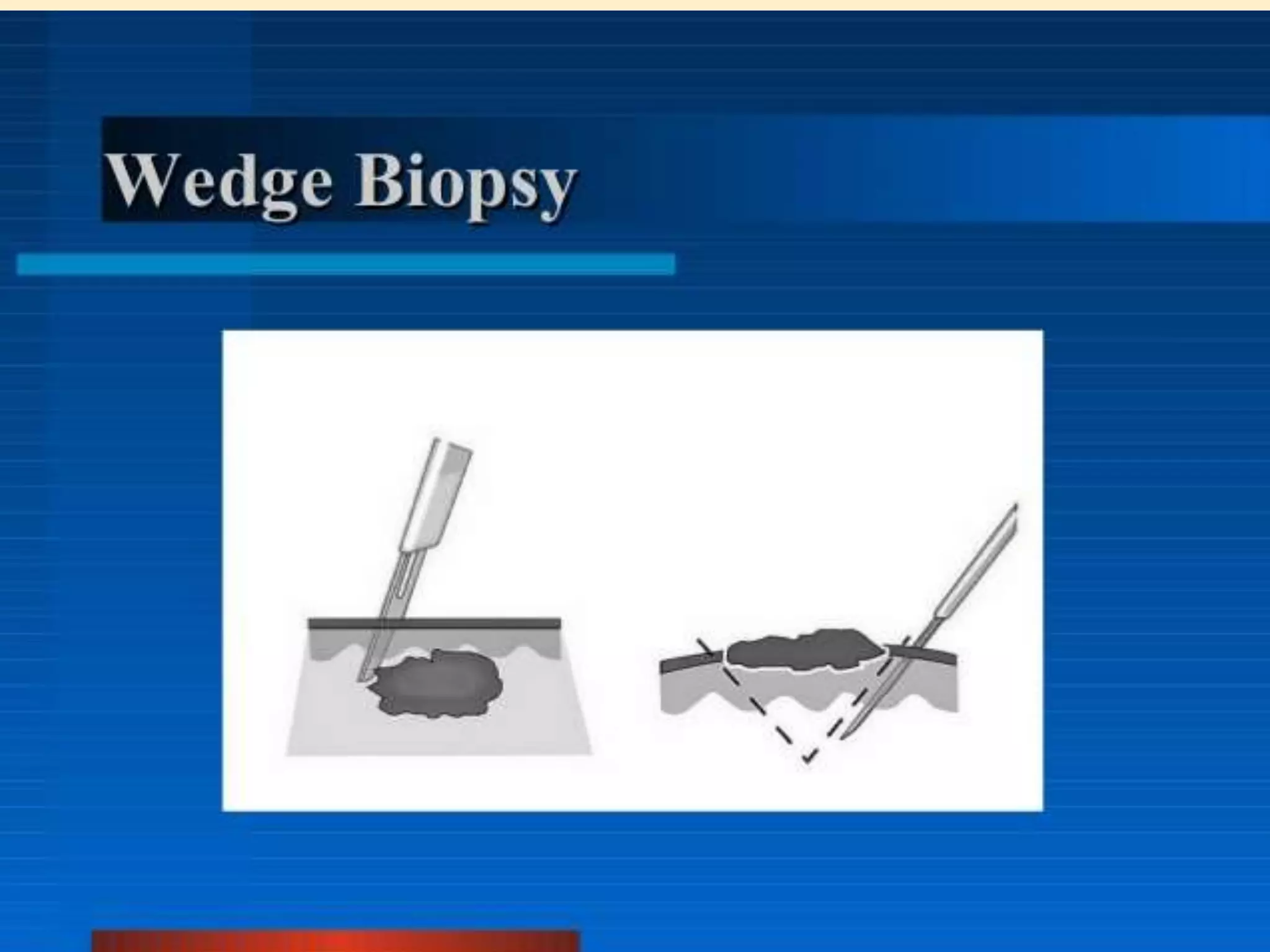 Biopsy and Exfoliative Cytology | PPTX
