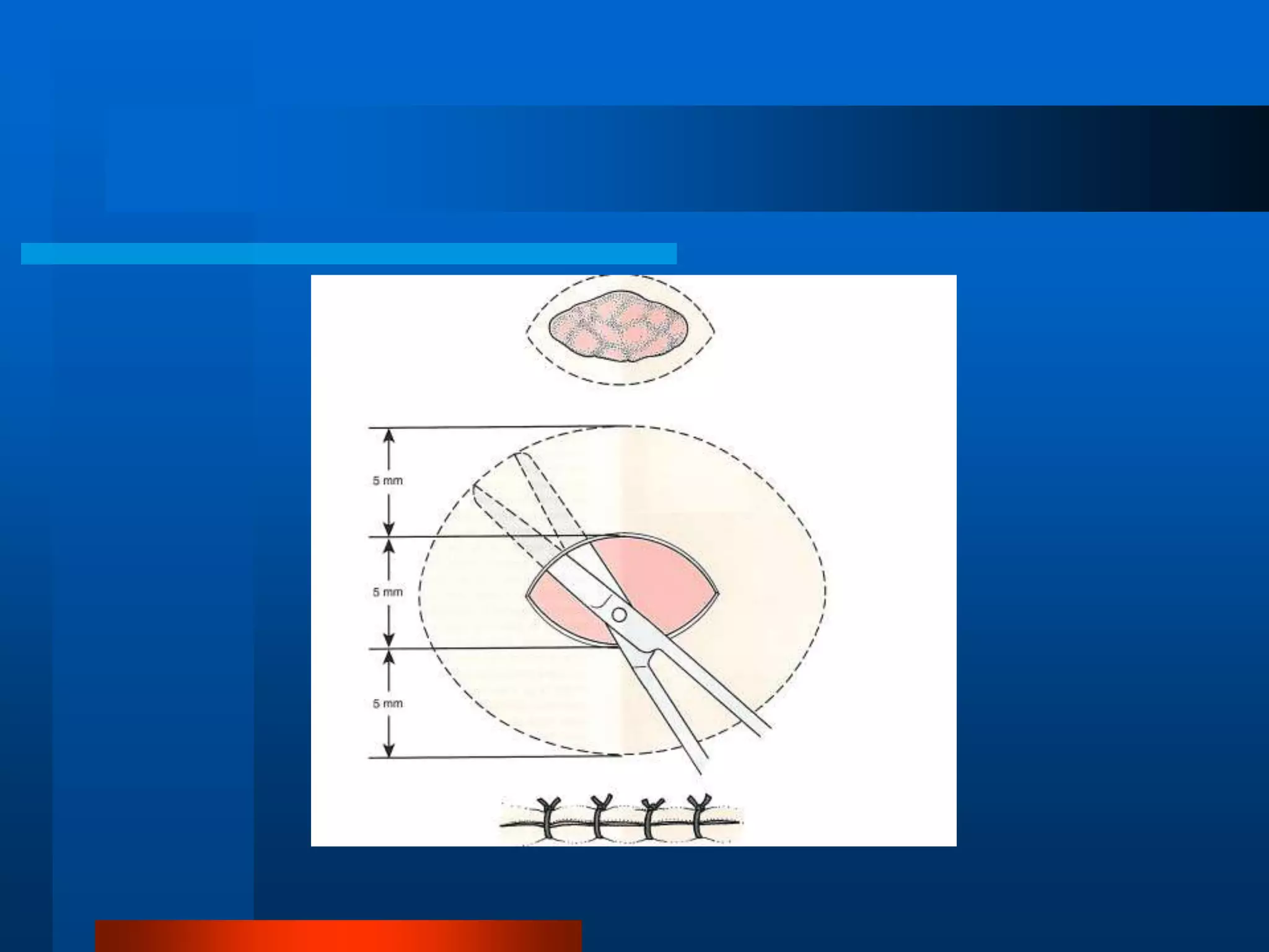 Principles and Techniques of Biopsy | PPT