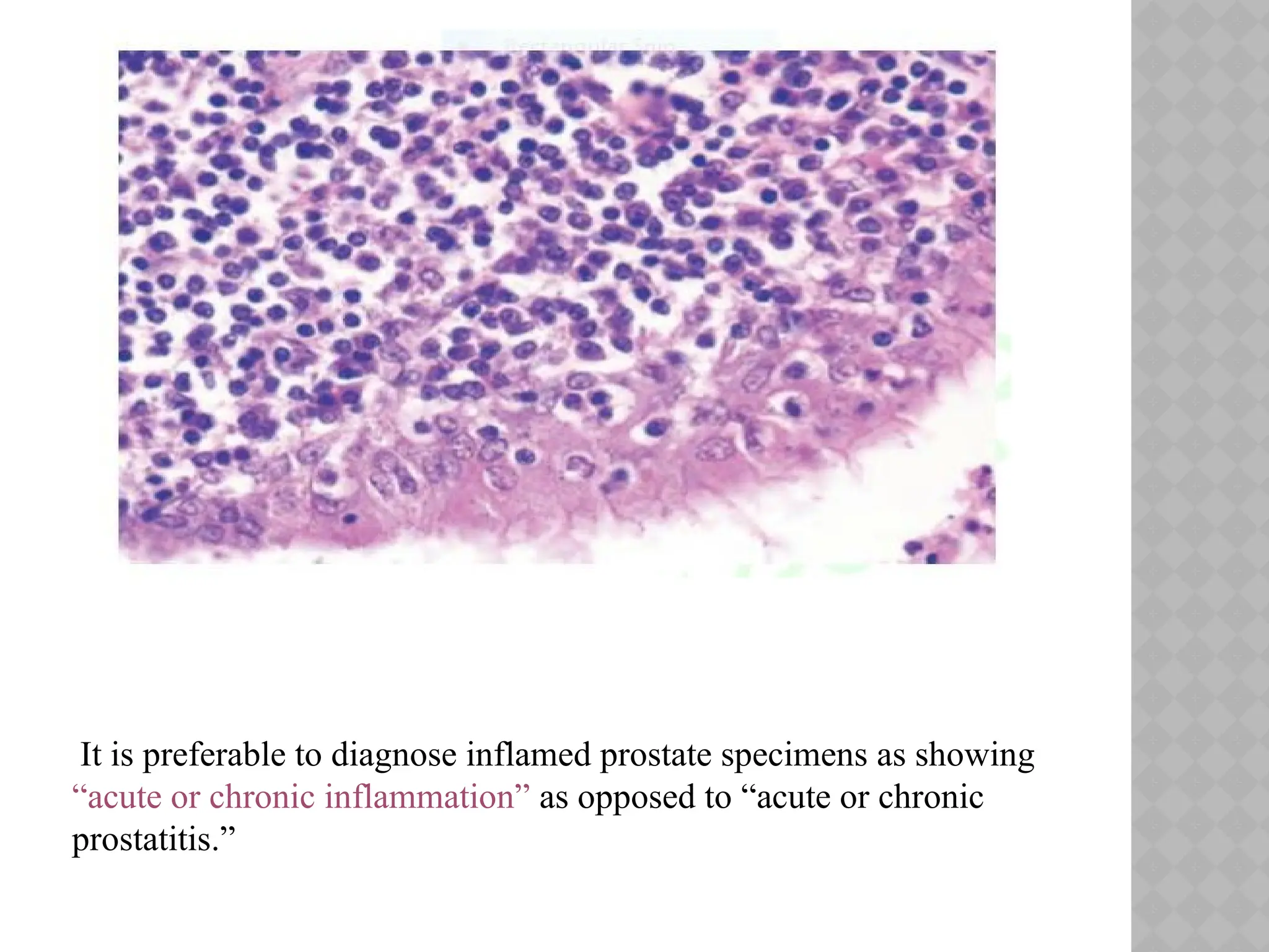 Biopsy interpretation of prostate disease | PPTX