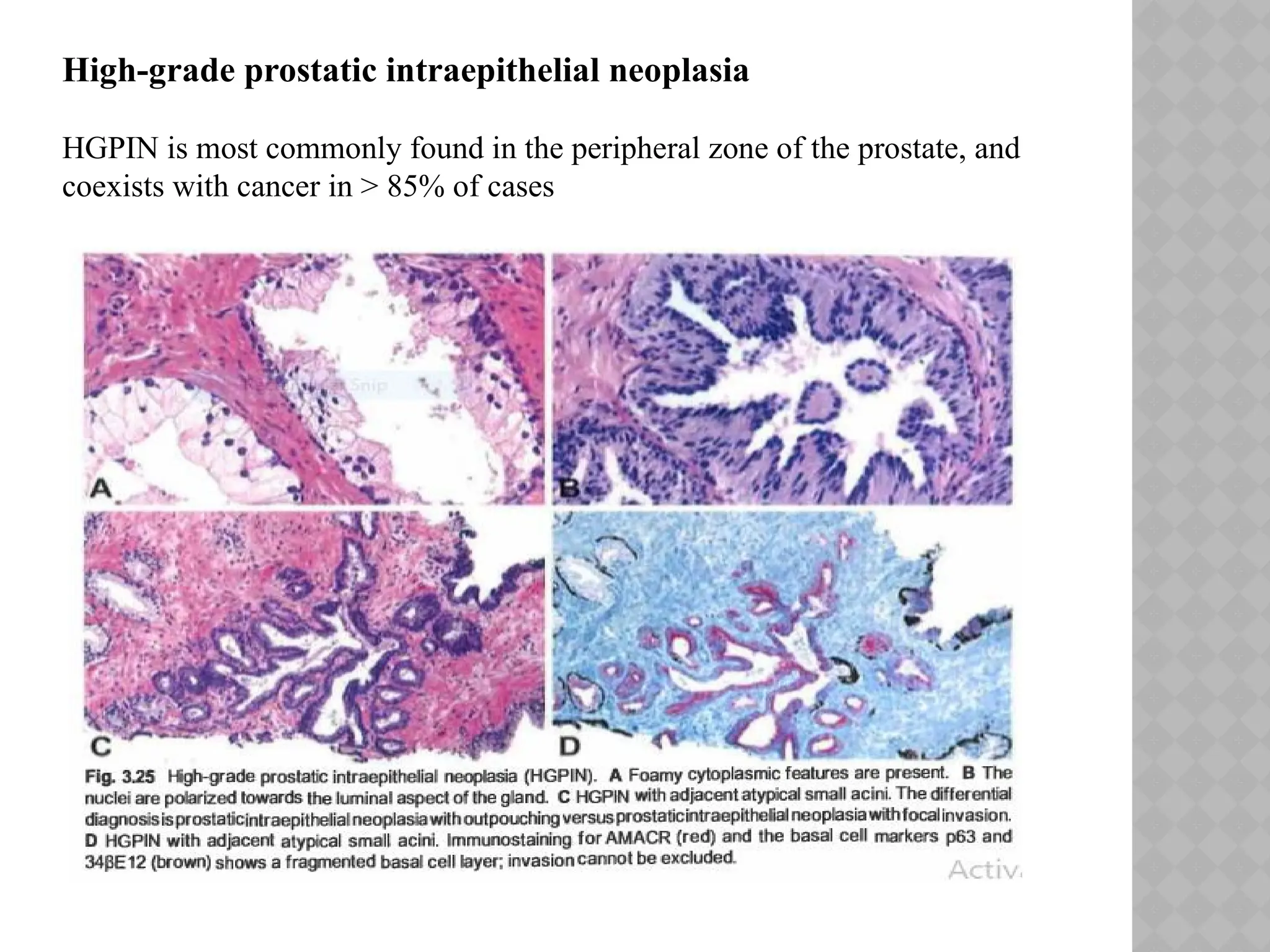 Biopsy interpretation of prostate disease | PPTX