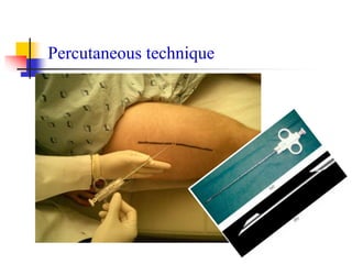 Biopsy_of_musculoskeletal_tumors (3).ppt
