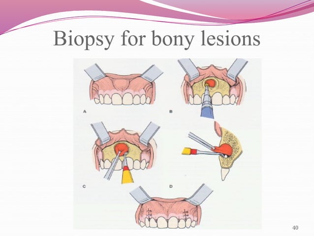 Biopsy & Aspiration Cytology in Oral and Maxillofacial Surgery | PPTX