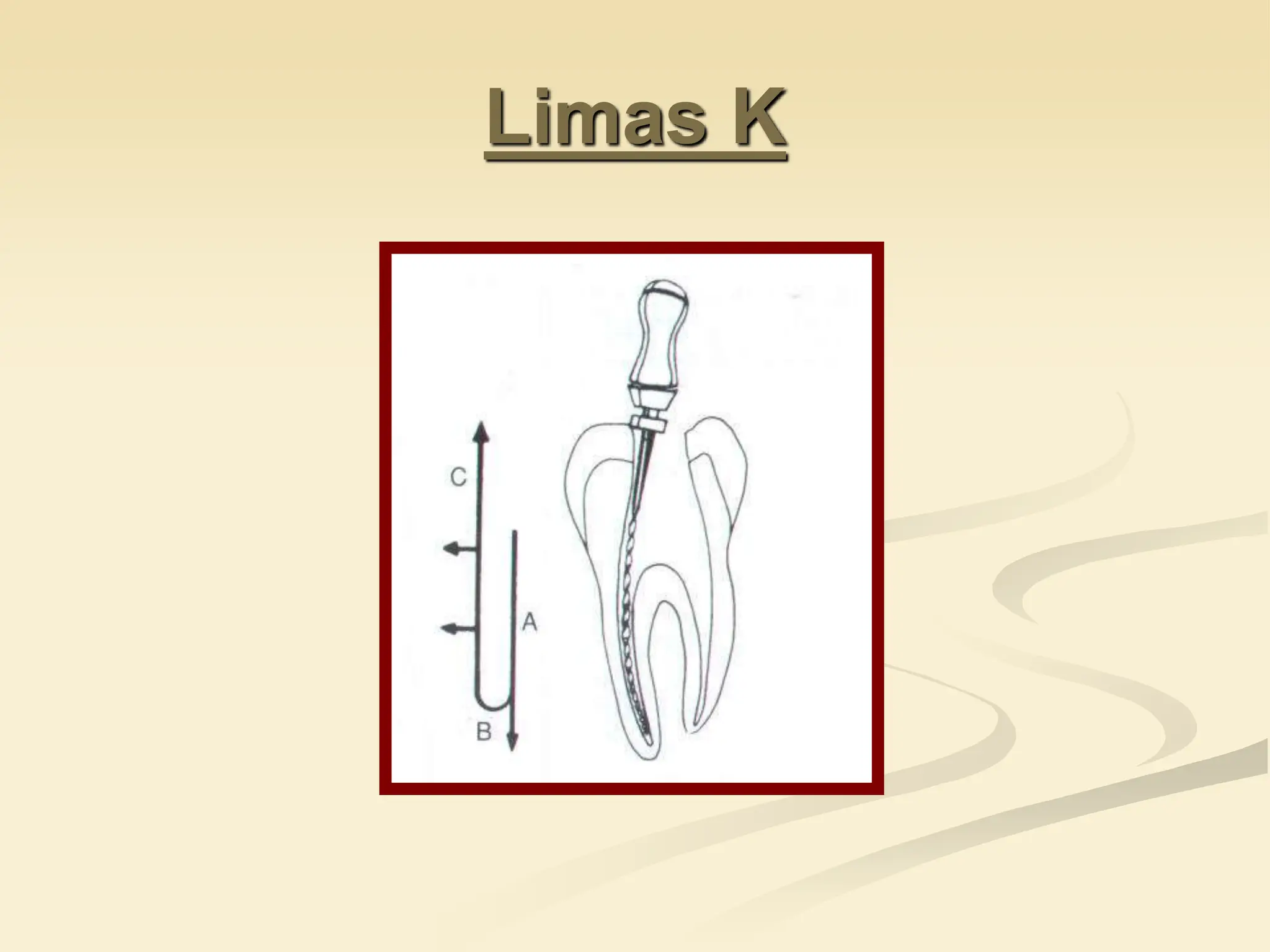 Biopulpectomia total (pulpitis irreversible) (2).ppt | Dental Health ...