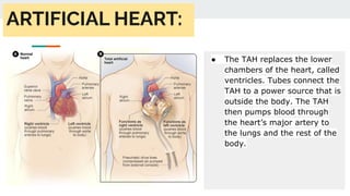 Bio Sensors and Artificial Heart Technology | PPT