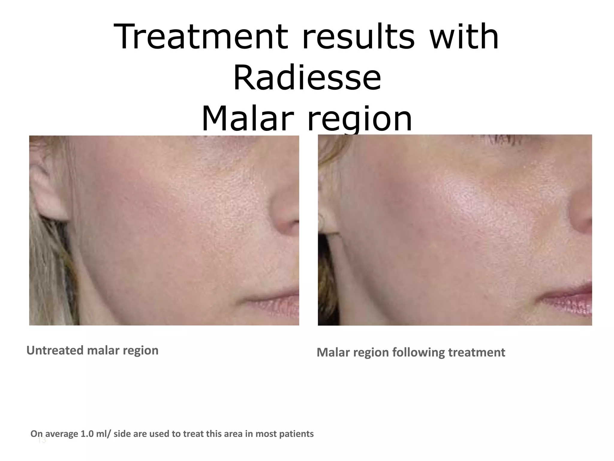 Biostimulant dermal fillers | PPTX