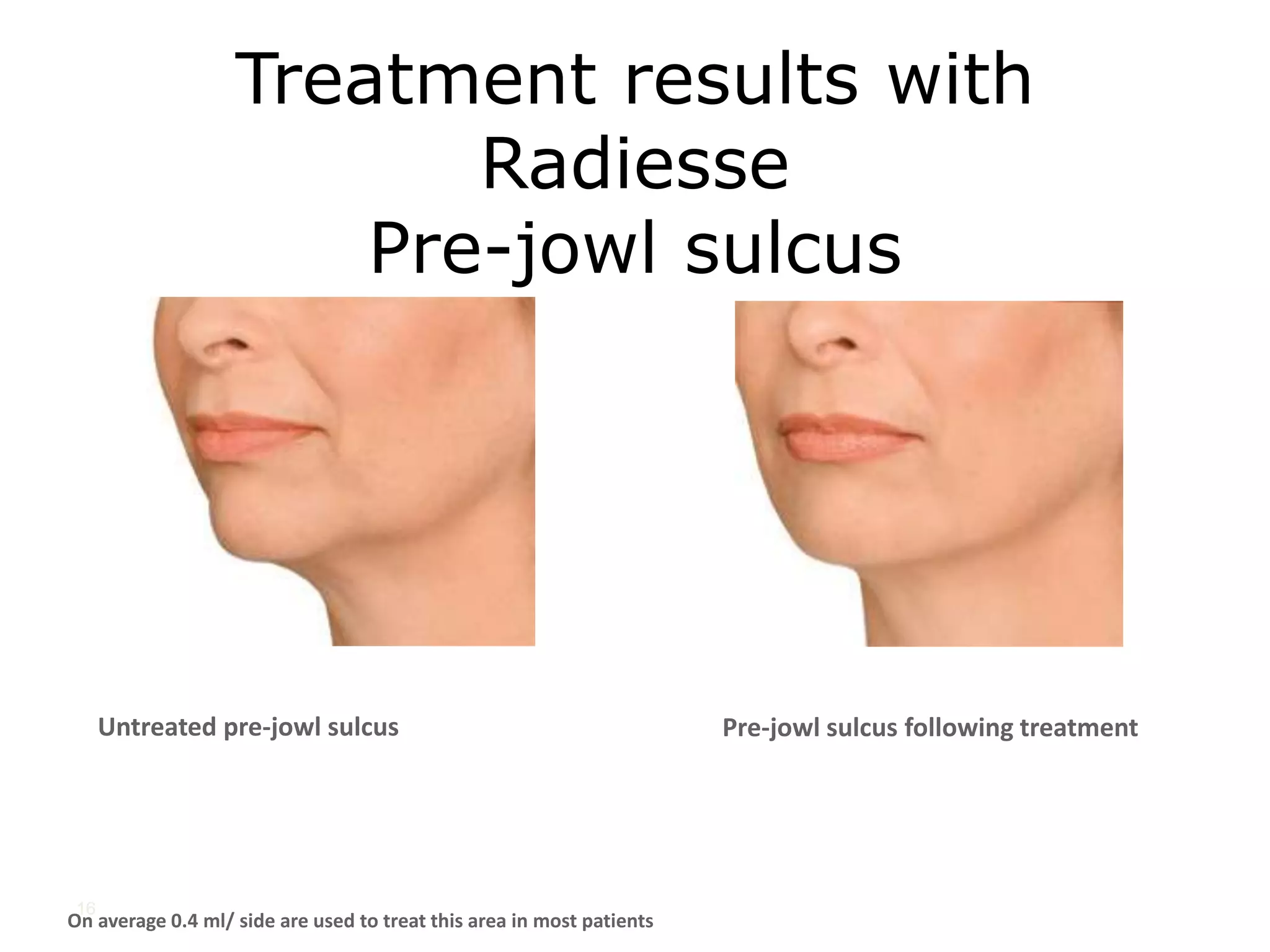 Biostimulant dermal fillers | PPTX