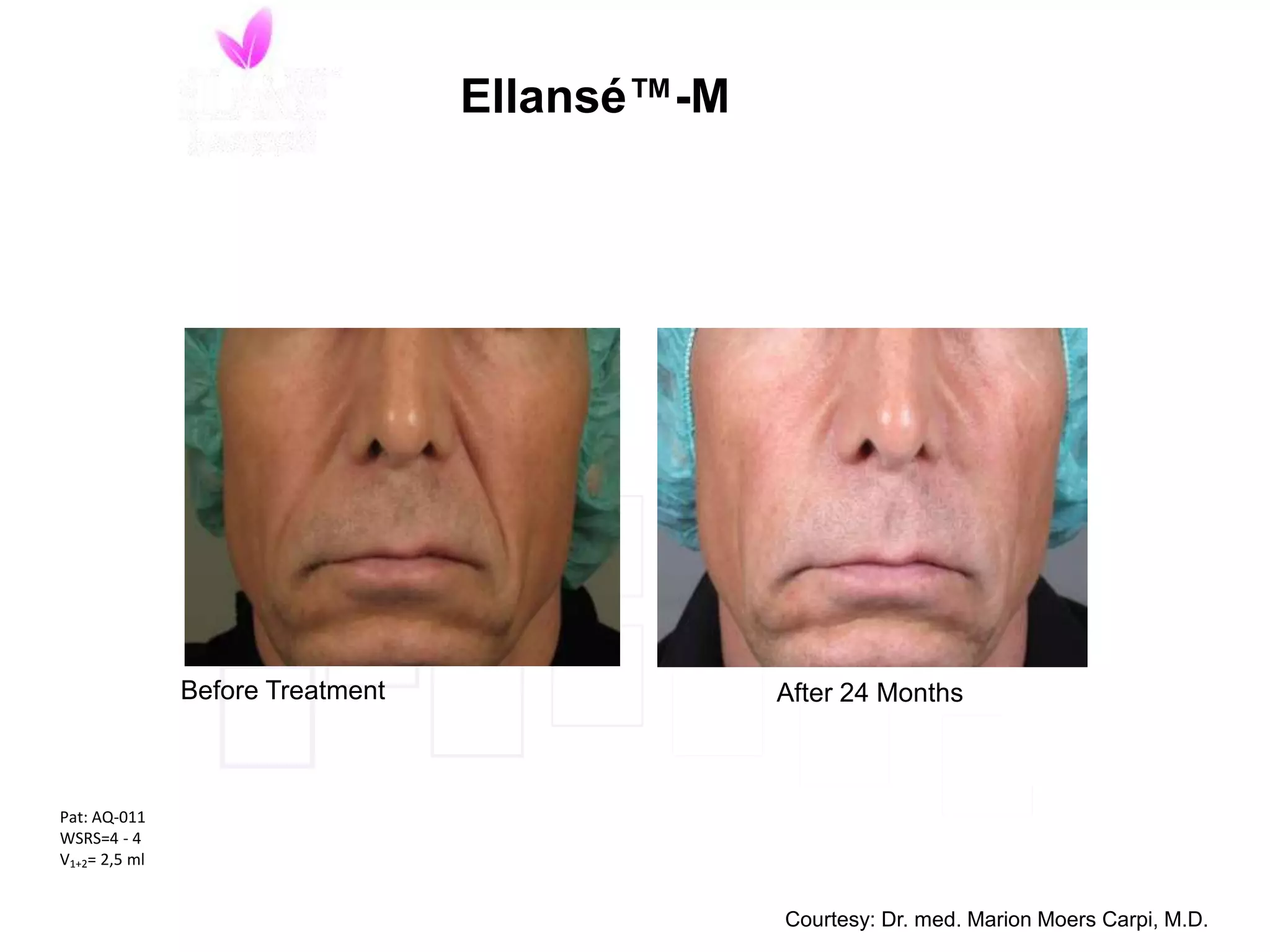 Biostimulant dermal fillers | PPTX