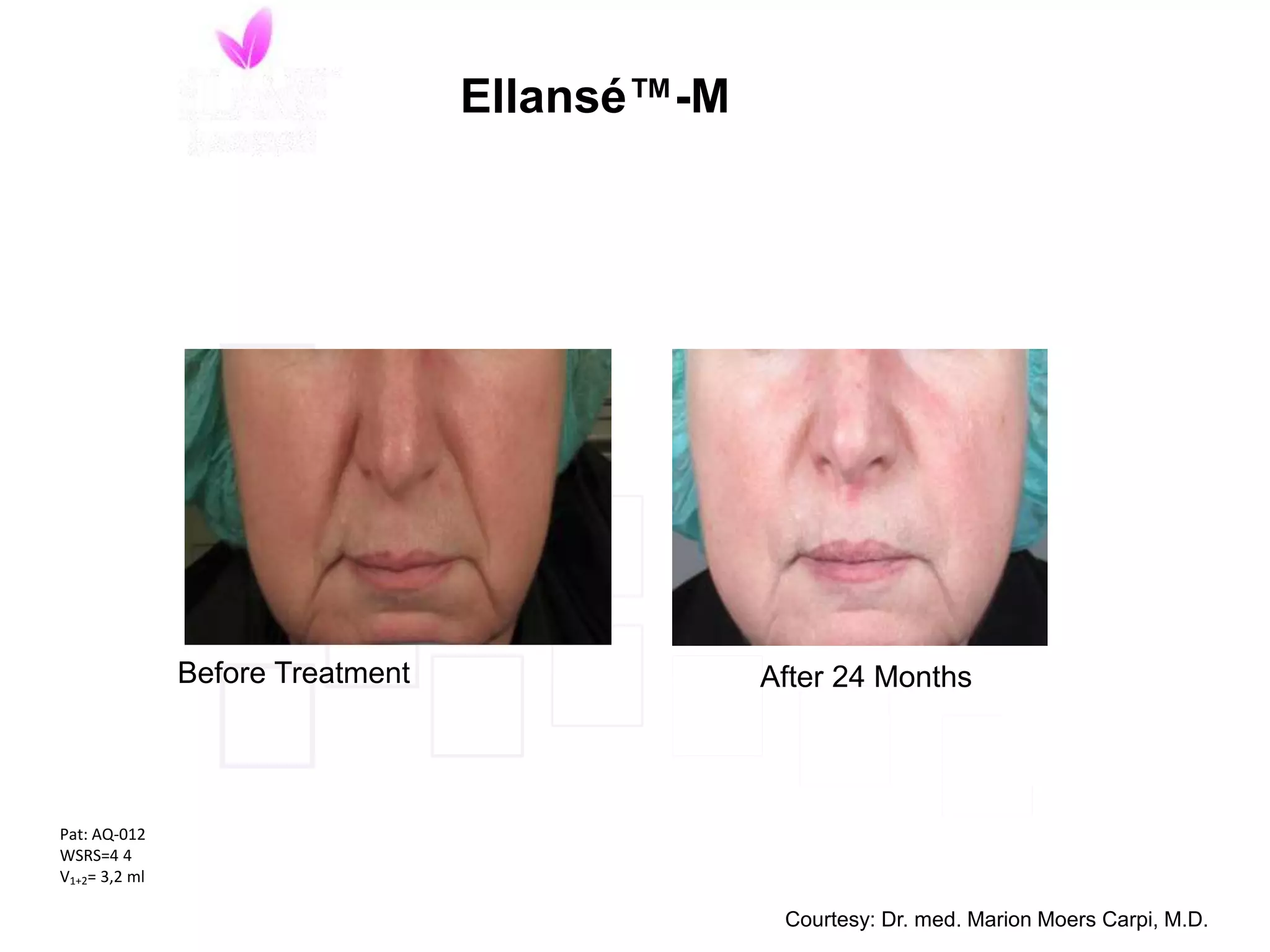 Biostimulant dermal fillers | PPTX