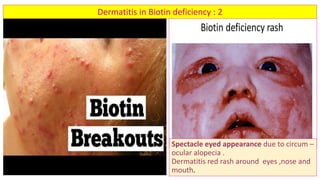 Biotin Deficiency Rash