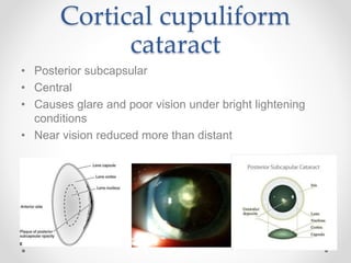 Biovisioncataract 150313155256-conversion-gate01 | PPT
