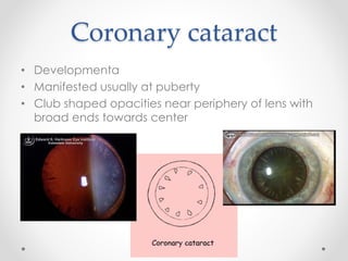 Cataract | PPSX