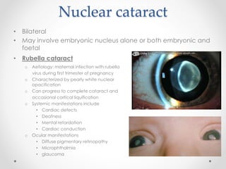 Cataract | PPSX