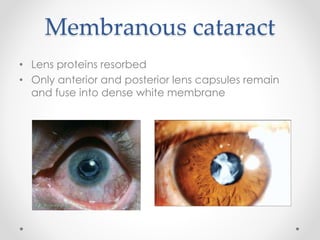 Cataract | PPSX