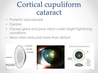 Cataract | PPSX