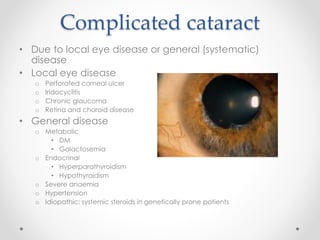 Cataract | PPSX
