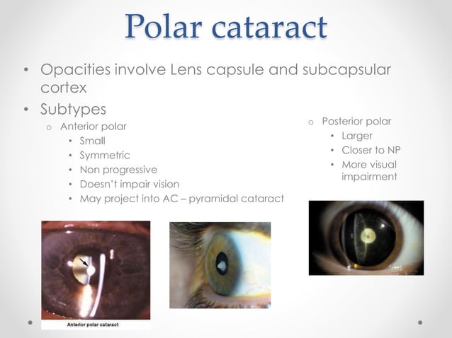 Cataract | PPSX | Eye and Vision Conditions | Diseases and Conditions