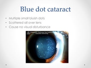 Blue Dot Cataract