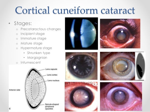 Cataract