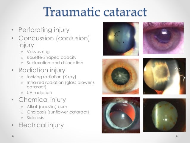 Cataract