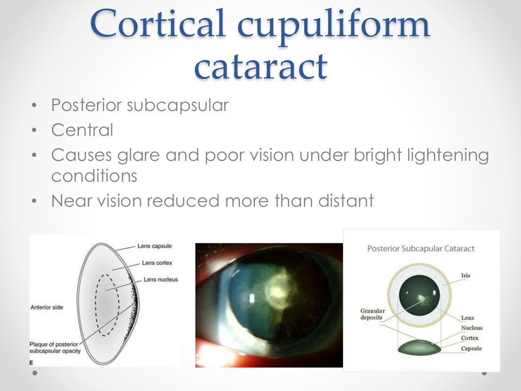 Cataract