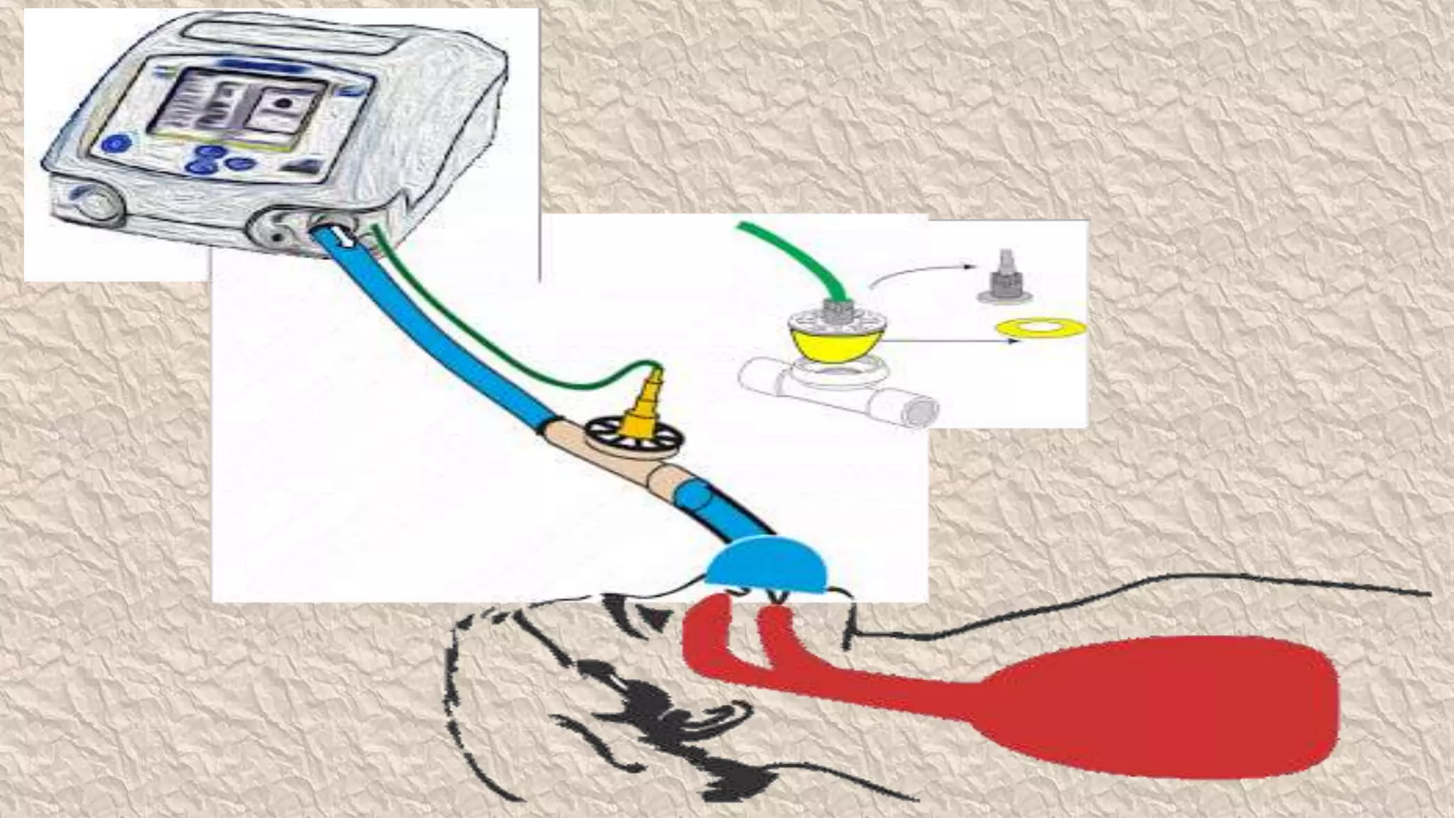 Bi pap machines | PPTX