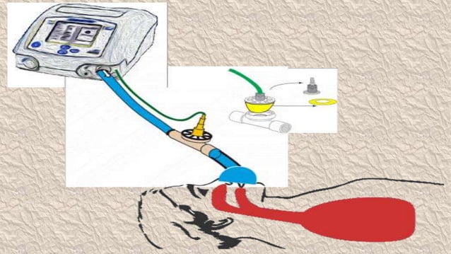 Bi pap machines | PPTX