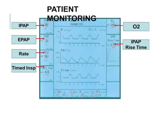 Bi pap -ppt | PPTX | Lung and Respiratory Health | Diseases and Conditions