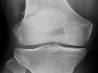Biparatite patella | PPTX