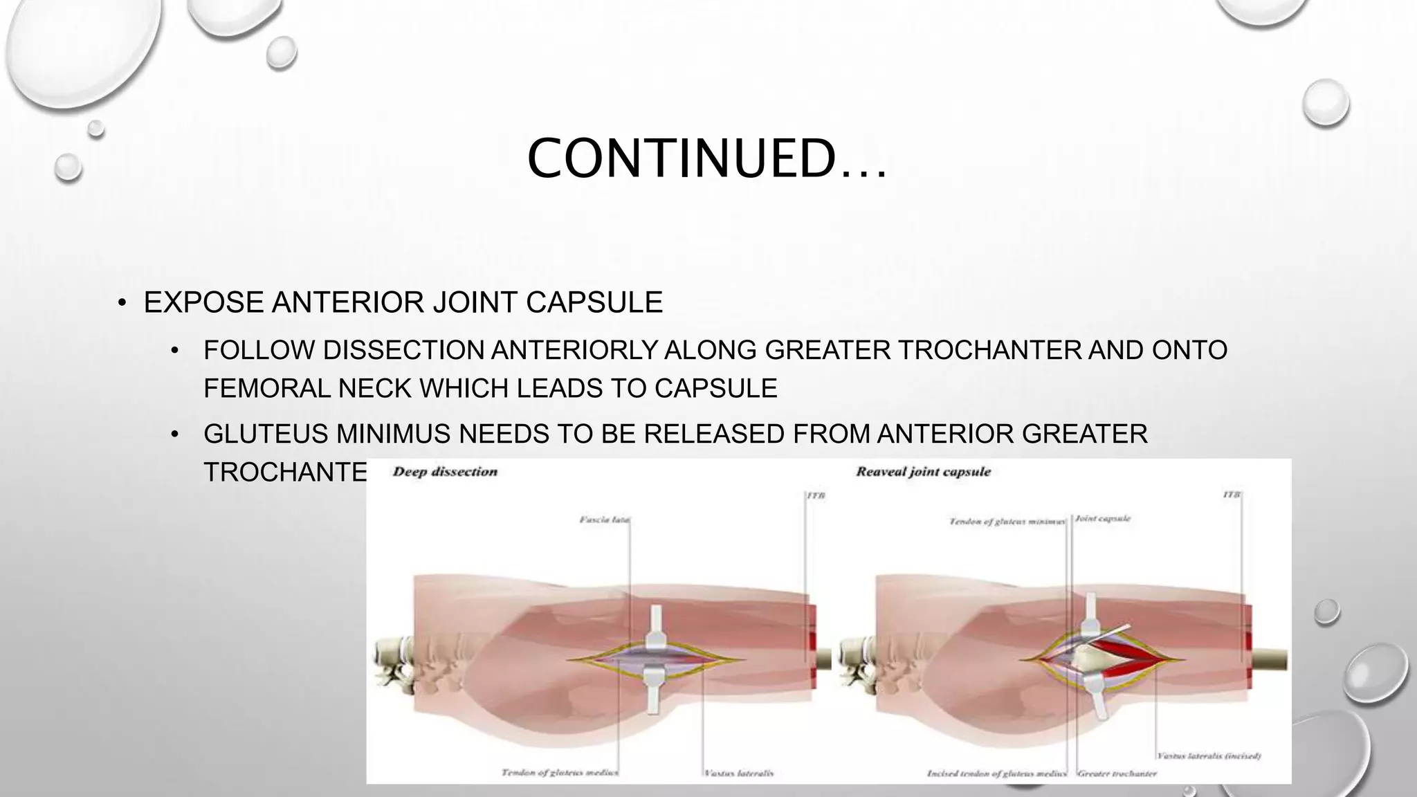 BIPOLAR HEMIARTHROPLASTY (1).pptx