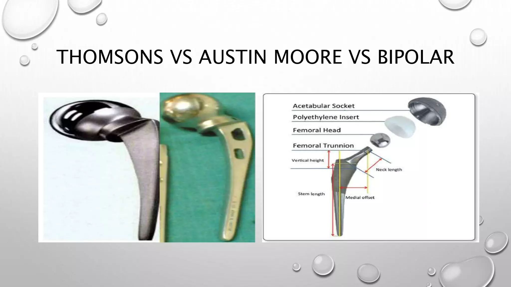 BIPOLAR HEMIARTHROPLASTY (1).pptx