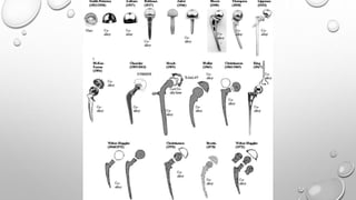 BIPOLAR HEMIARTHROPLASTY (1).pptx