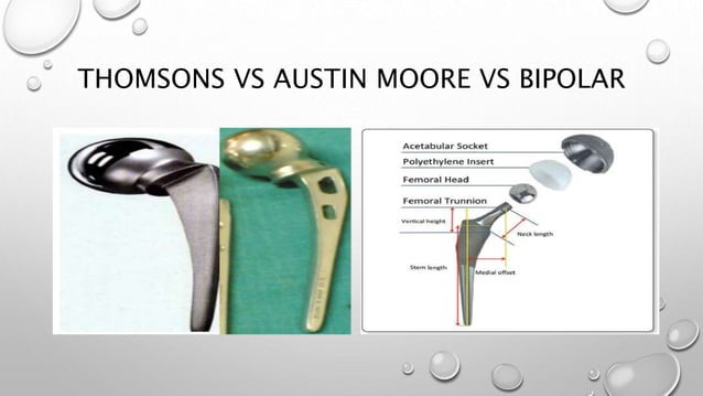 BIPOLAR HEMIARTHROPLASTY (1).pptx