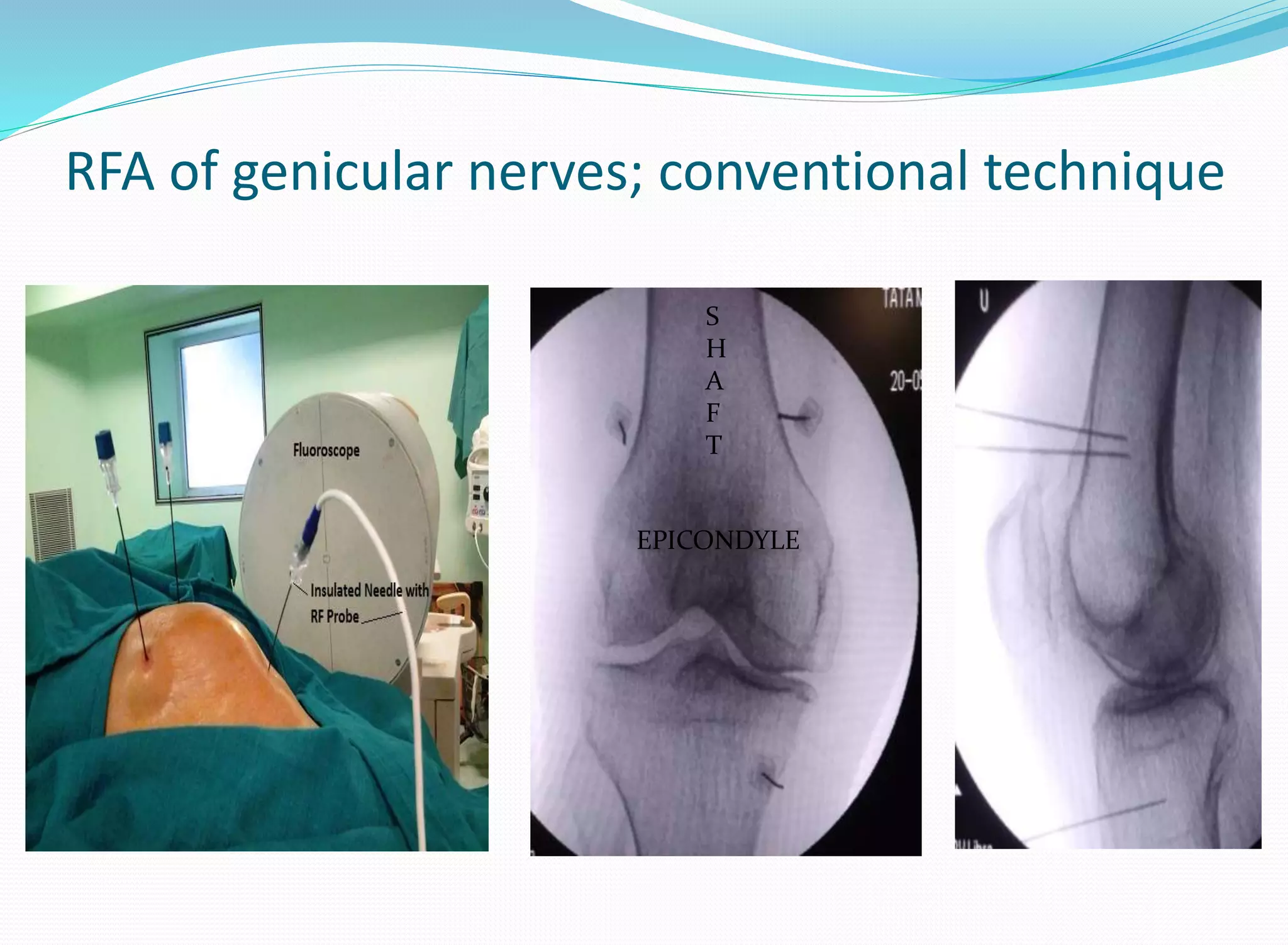 Bipolar RFA knee in Patients with Pacemaker | PPTX