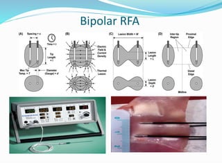 Bipolar RFA knee in Patients with Pacemaker | PPT | Free Download