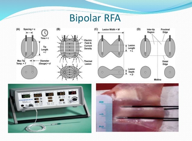 Bipolar RFA knee in Patients with Pacemaker