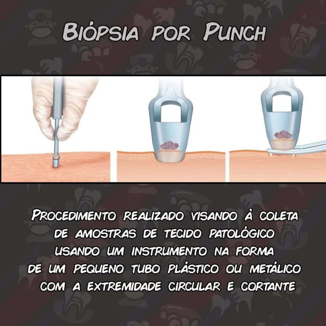 Biópsias em Odontologia - Incisional, Excisional, Punch, Citologia Es…