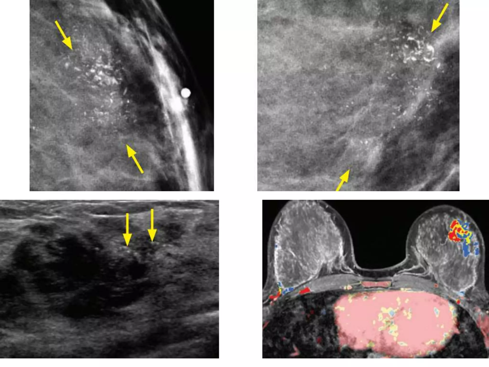 BIRADS, Breast Ultrasound, mamography | PPTX