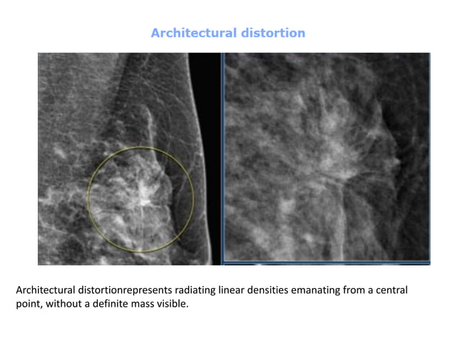 BIRADS, Breast Ultrasound, mamography | PPTX
